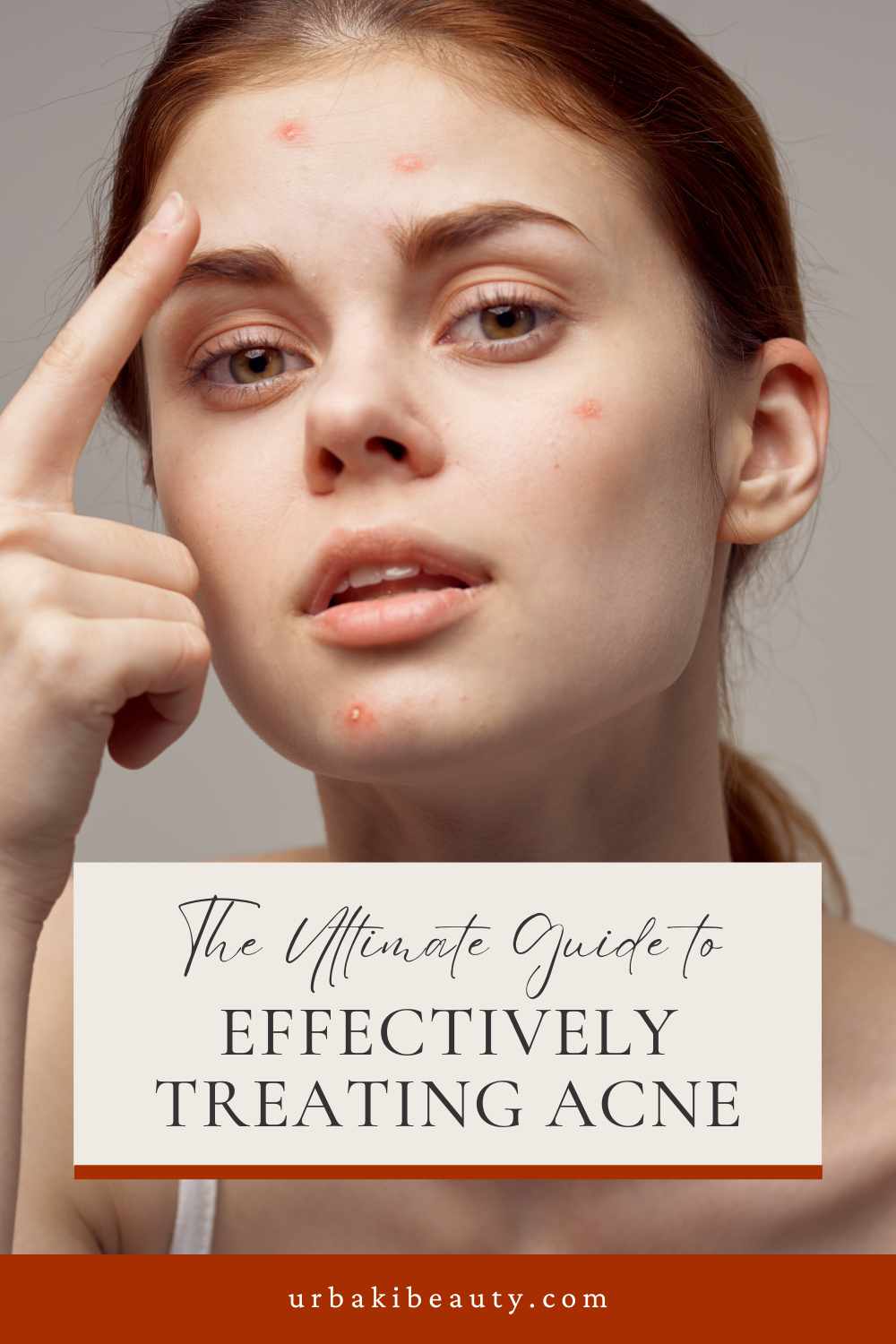 The Ultimate Guide to Effectively Treating Acne