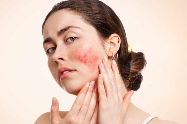 The Ultimate Guide to Understanding and Treating Rosacea