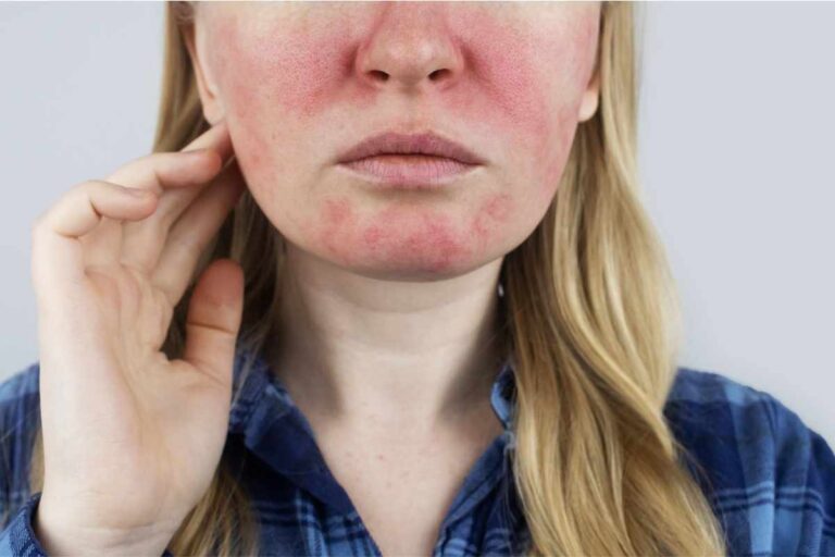 The Ultimate Guide to Understanding and Treating Rosacea