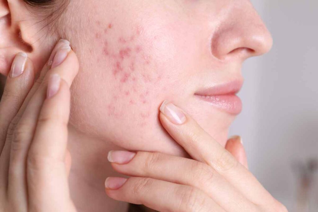 5 Daily Habits That Can Worsen Your Acne and How to Avoid Them