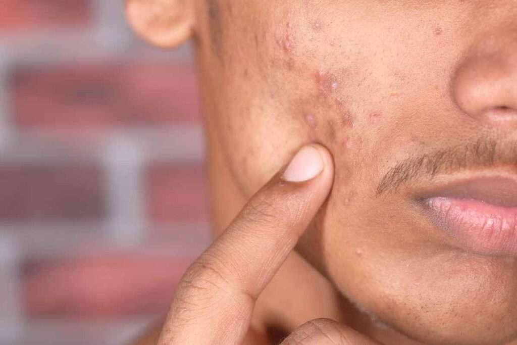 How to Combat Adult Acne in Men: Products and Routines
